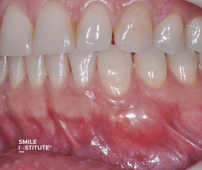 Smile Institute® – Complex Smile Makeover